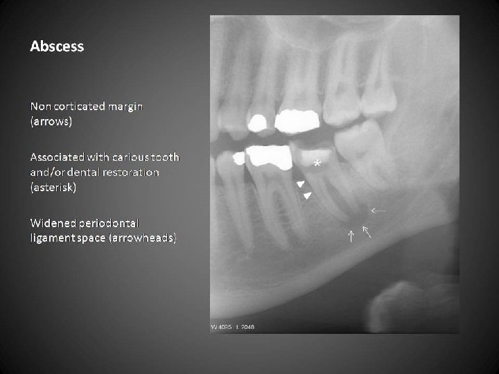 Apikale Parodontitis Definitionen Odontium Zahnschmelz Dentin Pulpa Apikale
