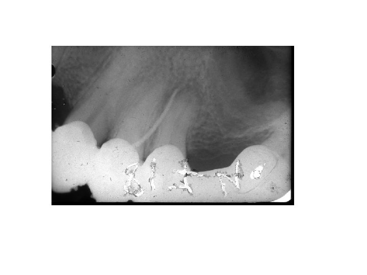 Apikale Parodontitis Definitionen Odontium Zahnschmelz Dentin Pulpa Apikale