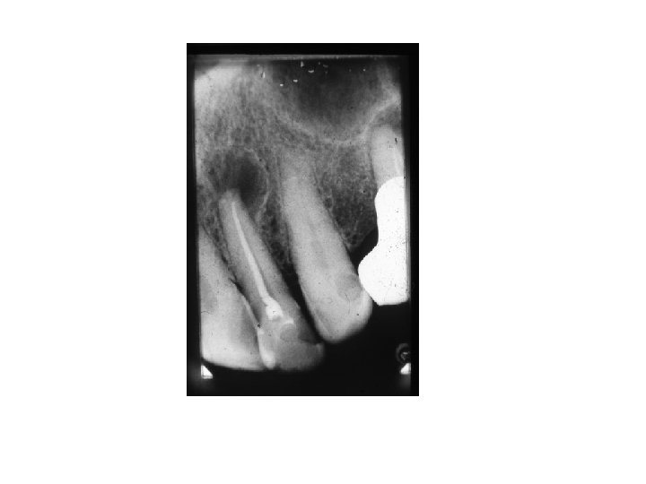 Apikale Parodontitis Definitionen Odontium Zahnschmelz Dentin Pulpa Apikale