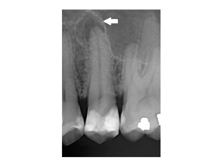 Apikale Parodontitis Definitionen Odontium Zahnschmelz Dentin Pulpa Apikale