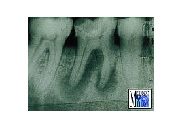 Apikale Parodontitis Definitionen Odontium Zahnschmelz Dentin Pulpa Apikale