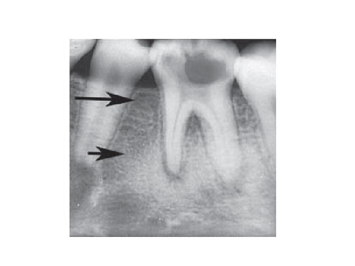 Apikale Parodontitis Definitionen Odontium Zahnschmelz Dentin Pulpa Apikale