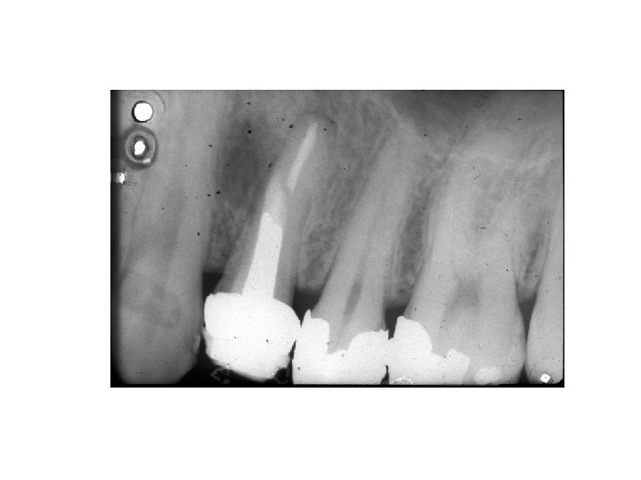 Apikale Parodontitis Definitionen Odontium Zahnschmelz Dentin Pulpa Apikale
