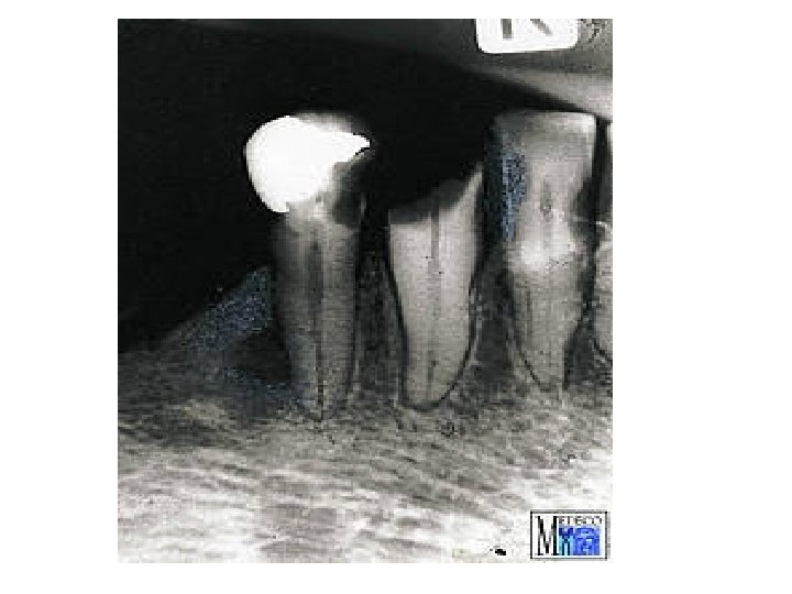 Apikale Parodontitis Definitionen Odontium Zahnschmelz Dentin Pulpa Apikale