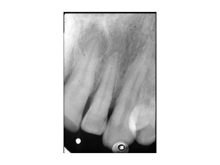 Apikale Parodontitis Definitionen Odontium Zahnschmelz Dentin Pulpa Apikale