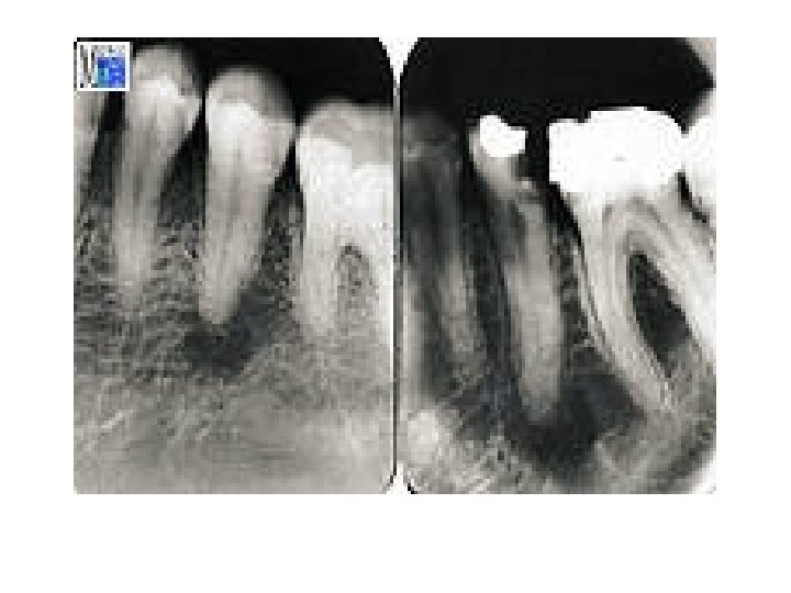 Apikale Parodontitis Definitionen Odontium Zahnschmelz Dentin Pulpa Apikale