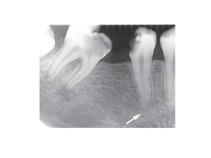 Apikale Parodontitis Definitionen Odontium Zahnschmelz Dentin Pulpa Apikale