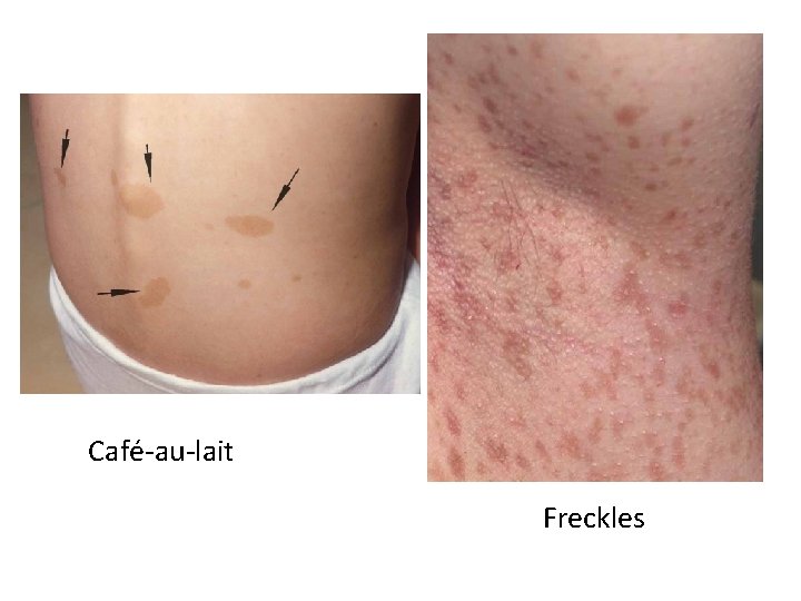 Neurofibromatosis Type 1 NF 1 Von Recklinghausen Disease