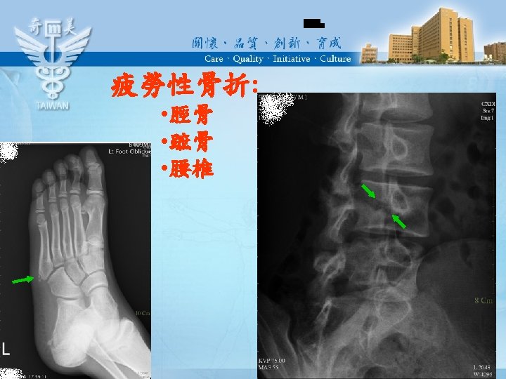 Heat Diseases EIB EIA Exercise Induced Asthma Bronchospasm