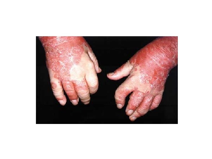 ERITROPAPULO SKUAMOSA DERMATOSIS ERITROPAPULOSKUAMOSA DERMATOSIS ...