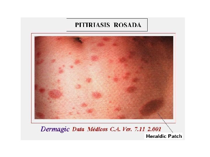 ERITROPAPULO SKUAMOSA DERMATOSIS ERITROPAPULOSKUAMOSA DERMATOSIS ...