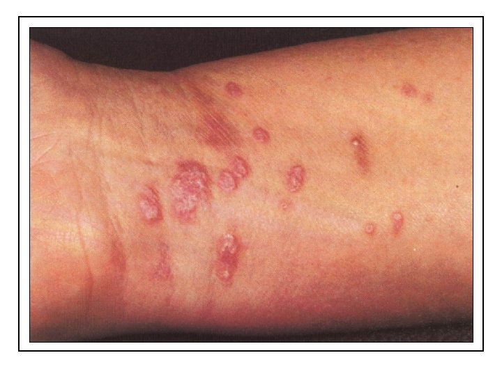 ERITROPAPULO SKUAMOSA DERMATOSIS ERITROPAPULOSKUAMOSA DERMATOSIS ...