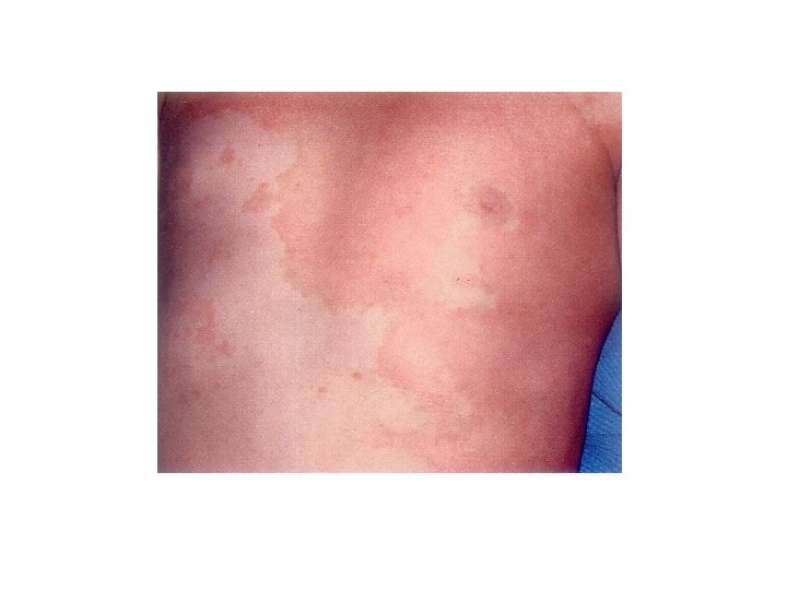 ERITROPAPULO SKUAMOSA DERMATOSIS ERITROPAPULOSKUAMOSA DERMATOSIS ...