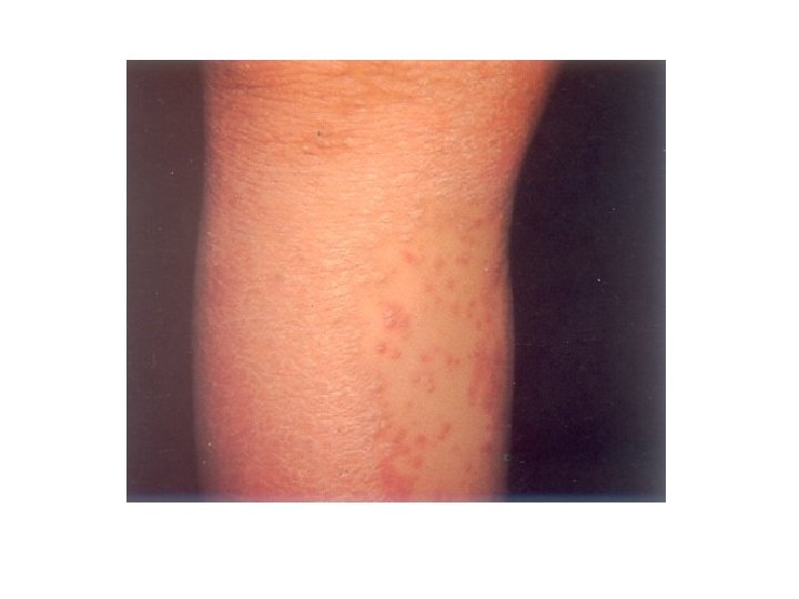 ERITROPAPULO SKUAMOSA DERMATOSIS ERITROPAPULOSKUAMOSA DERMATOSIS ...