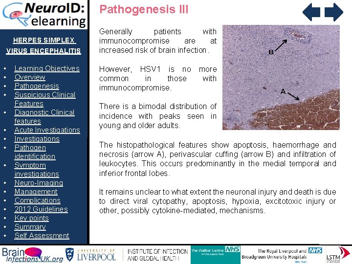 HERPES SIMPLEX VIRUS ENCEPHALITIS Learning Objectives Overview Pathogenesis