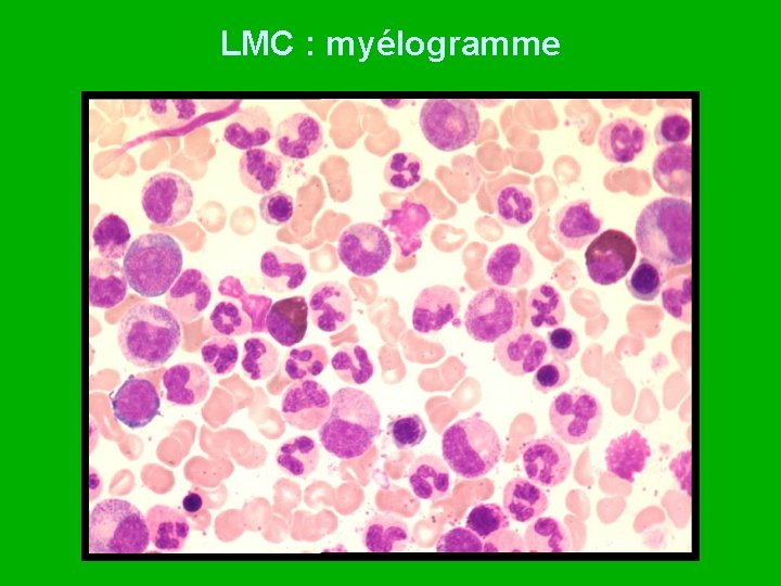 SYNDROMES MYELOPROLIFERATIFS Dr R KOKODE CHU K Bictre