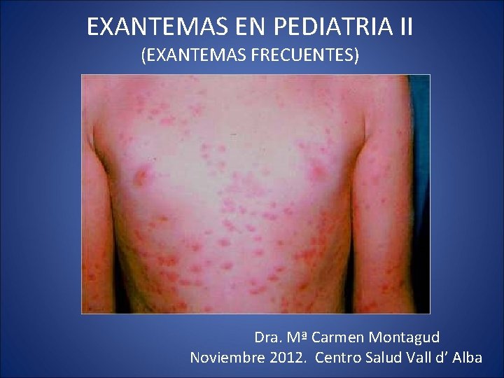 EXANTEMAS EN PEDIATRIA II EXANTEMAS FRECUENTES Dra M