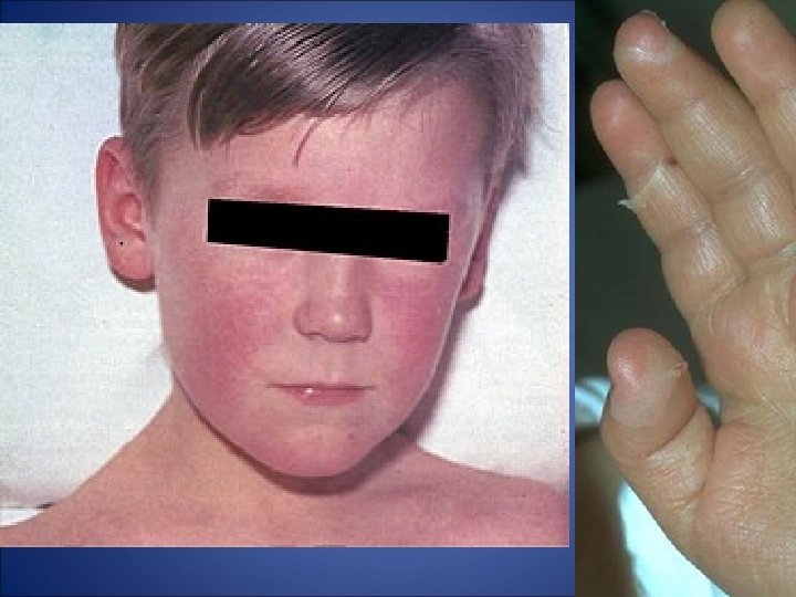 EXANTEMAS EN PEDIATRIA II EXANTEMAS FRECUENTES Dra M