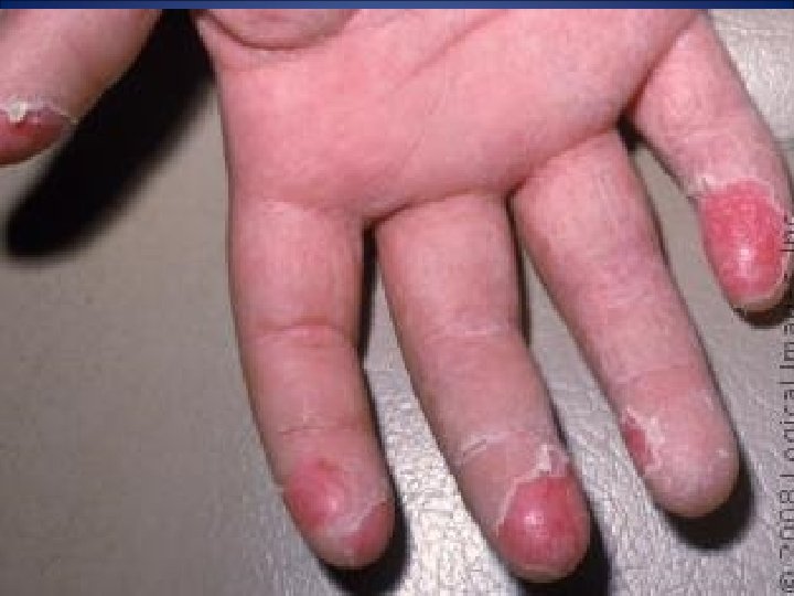 EXANTEMAS EN PEDIATRIA II EXANTEMAS FRECUENTES Dra M