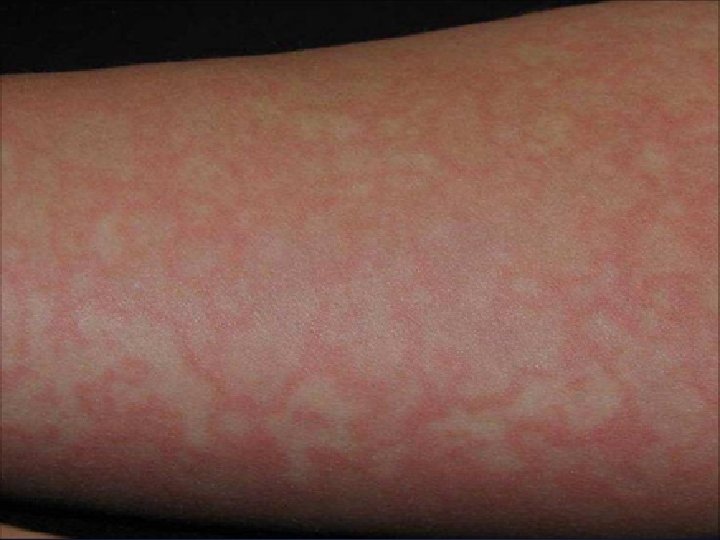 EXANTEMAS EN PEDIATRIA II EXANTEMAS FRECUENTES Dra M