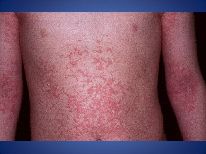 EXANTEMAS EN PEDIATRIA II EXANTEMAS FRECUENTES Dra M