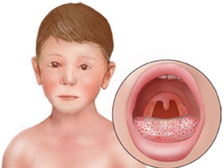 EXANTEMAS EN PEDIATRIA II EXANTEMAS FRECUENTES Dra M