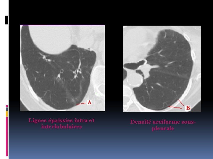 LE SYNDROME INTERSTITIEL Dr BENZALIM Dr MRABTI PLAN