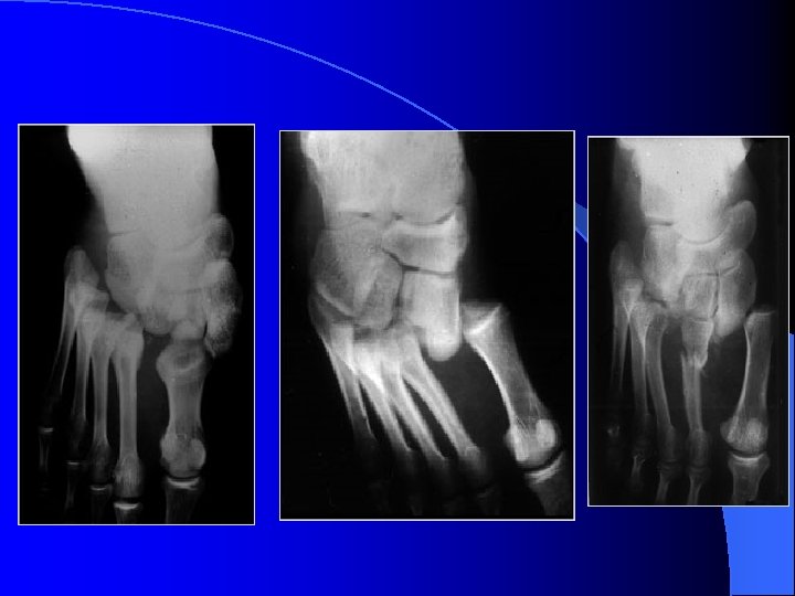 Traumatismes du pied Importance Os de contact et