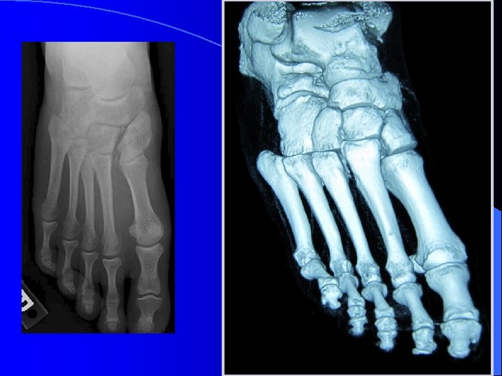 Traumatismes du pied Importance Os de contact et