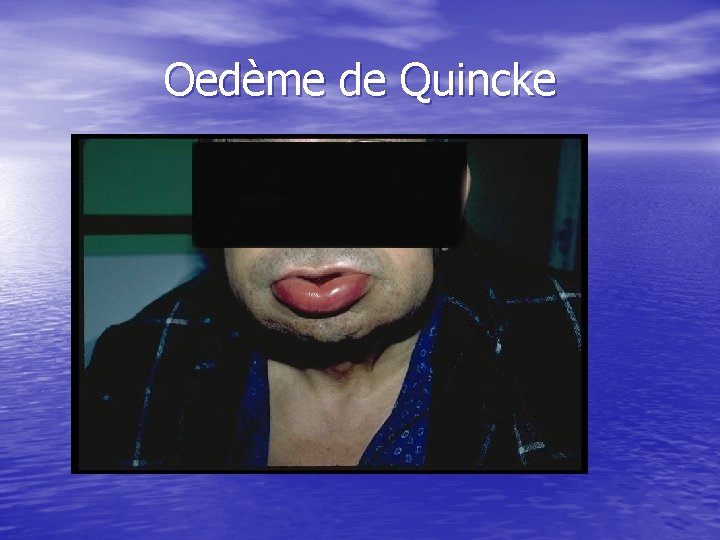 URTICAIRE 1 DEFINITION Eruption cutane ou cutanomuqueuse papuleuse