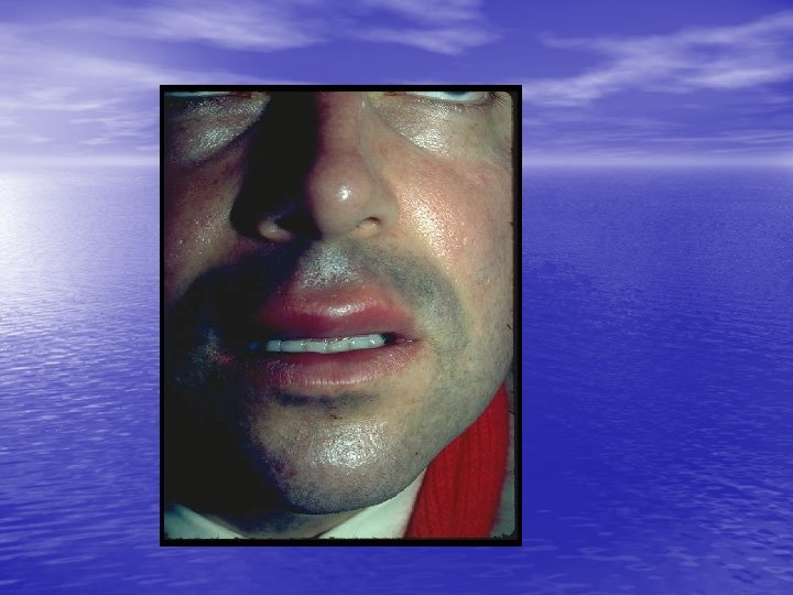 URTICAIRE 1 DEFINITION Eruption cutane ou cutanomuqueuse papuleuse