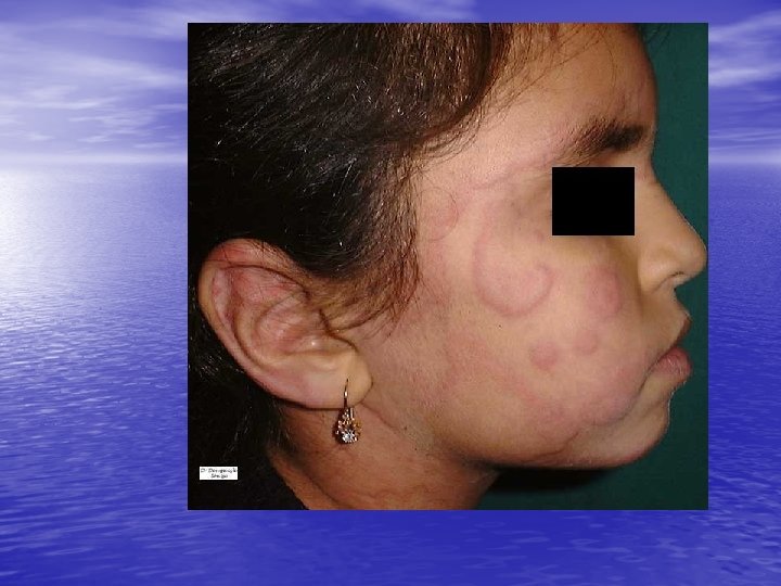 URTICAIRE 1 DEFINITION Eruption cutane ou cutanomuqueuse papuleuse