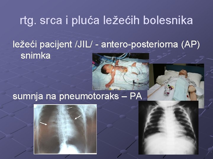 KONVENCIONALNE RADIOLOKE METODE RTG PREGLEDI TORAKALNIH ORGANA Prof