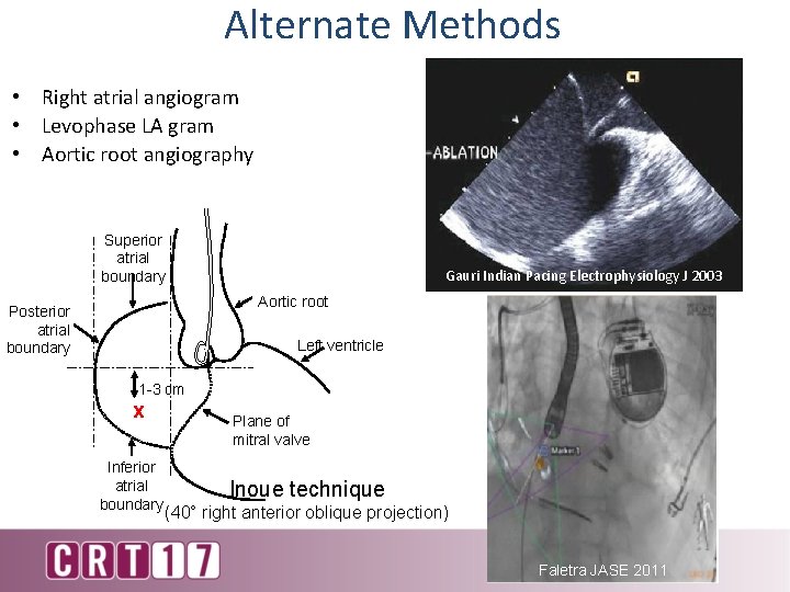How to Perform a Successful Transseptal Puncture Zoltan