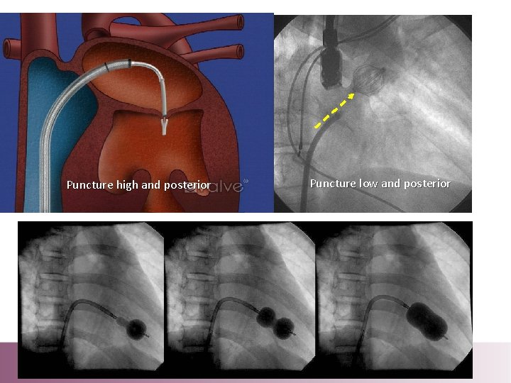 How to Perform a Successful Transseptal Puncture Zoltan