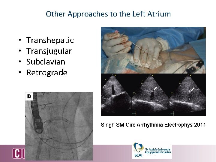 How to Perform a Successful Transseptal Puncture Zoltan