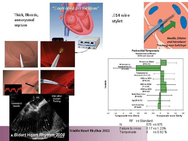 How to Perform a Successful Transseptal Puncture Zoltan