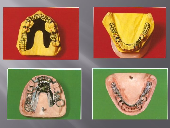 Work AUTHORIZATION FOR REMOVABLE PARTIAL DENTURES A work
