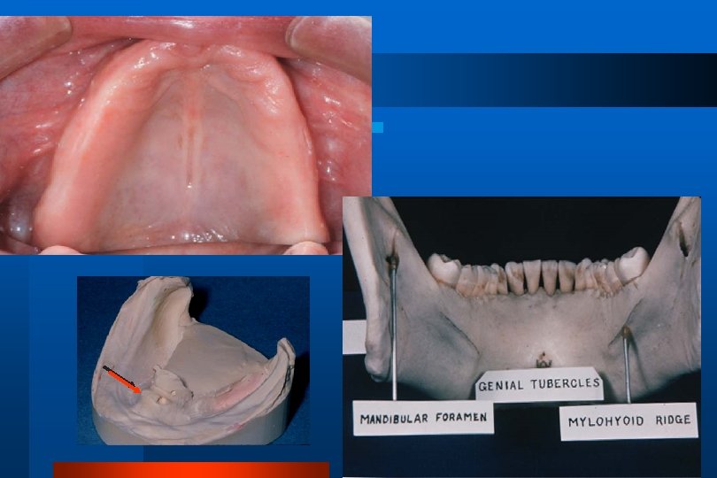 Examination Diagnosis and Treatment Planning for Edentulous or