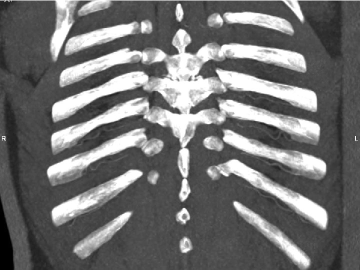 TORAKAL DRENAJLAR Dr Trkmen ifti HTF Radyoloji AD