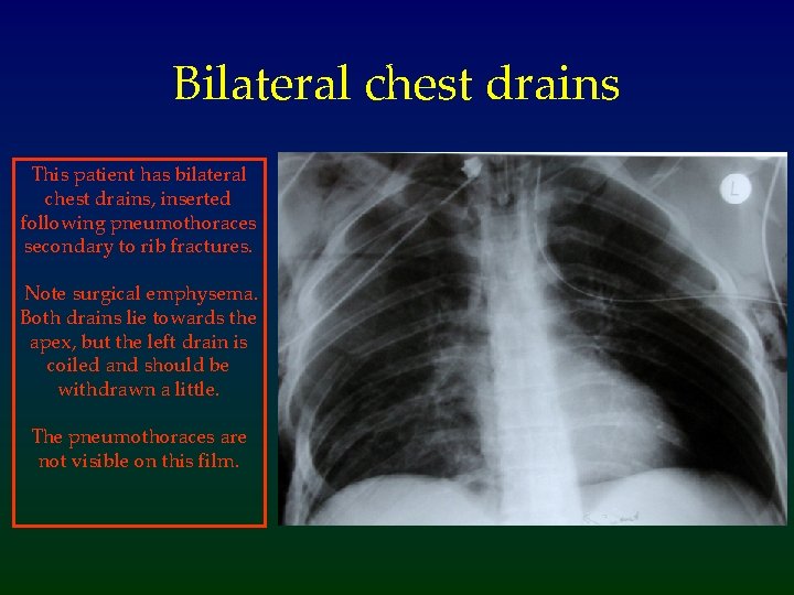 Lines and Tubes What are the common lines
