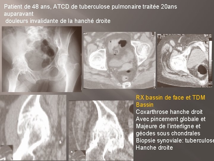 TUBERCULOSE OSTEOARTICULAIRE EXTRA RACHIDIENNE ASPECT EN IMAGERIE A