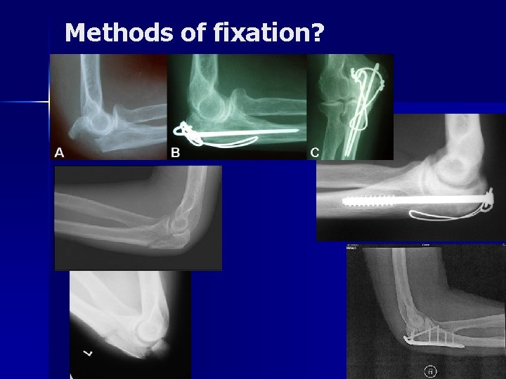 Olecranon fracture Lonnie Froberg MD Ph D Odense