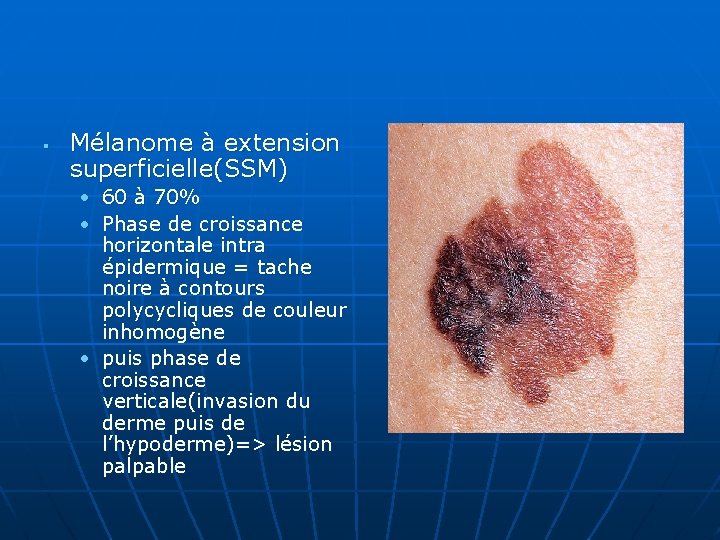 LE MELANOME MALIN Dr LE CLECH COMMENT RECONNATRE