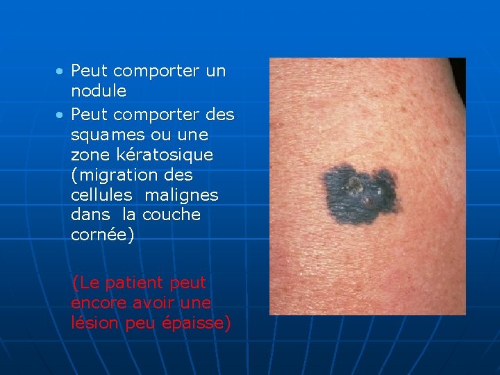 LE MELANOME MALIN Dr LE CLECH COMMENT RECONNATRE