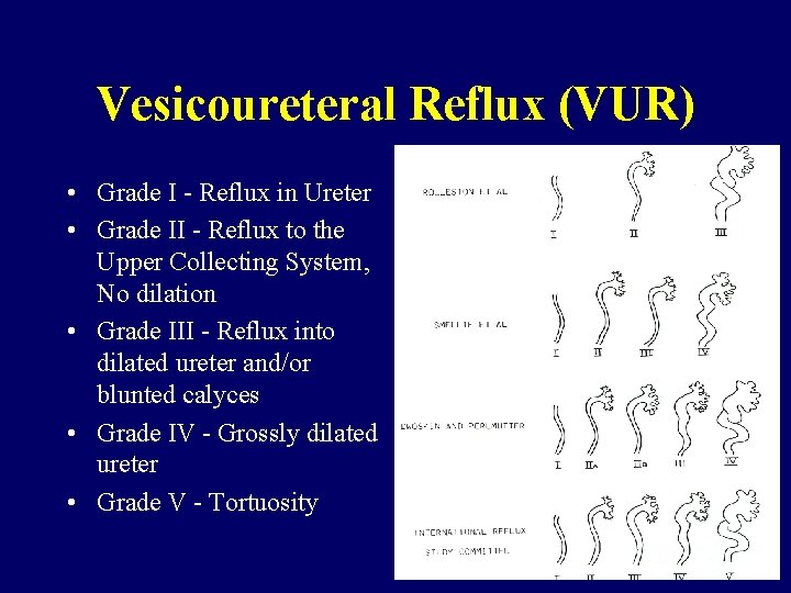 Imaging Studies after a First Febrile Urinary Tract