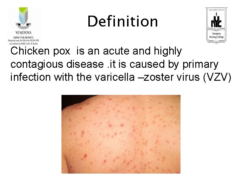 Unit XII Communicable disease CHICKENPOX REVIEWED BY PRESENTED