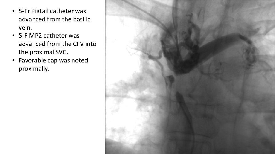 Endovascular Stenting for Superior Vena Cava Occlusion Secondary