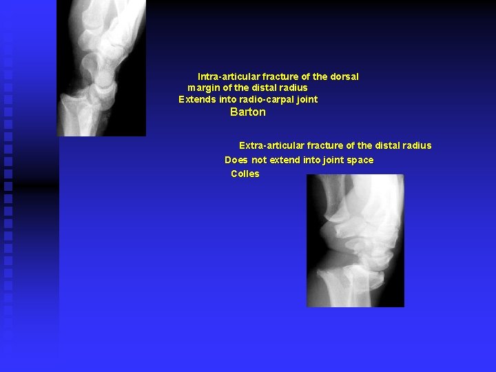 Traumatologia Introduo As fraturas do tero distal do