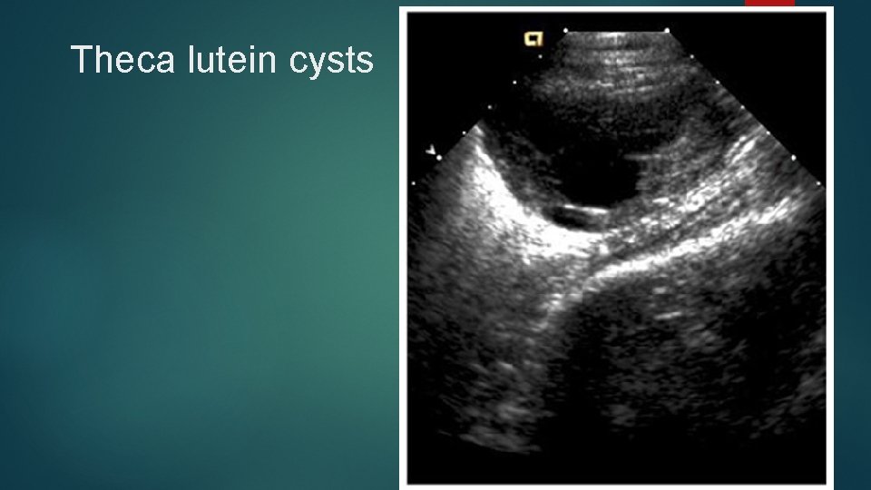 Molar Pregnancy GTD T ALLAMEH MD ASSOCIATED PROFESSOR